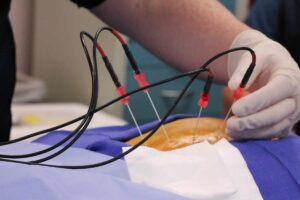 What Is Radiofrequency Ablation (RFA)? A Guide to Pain Relief
