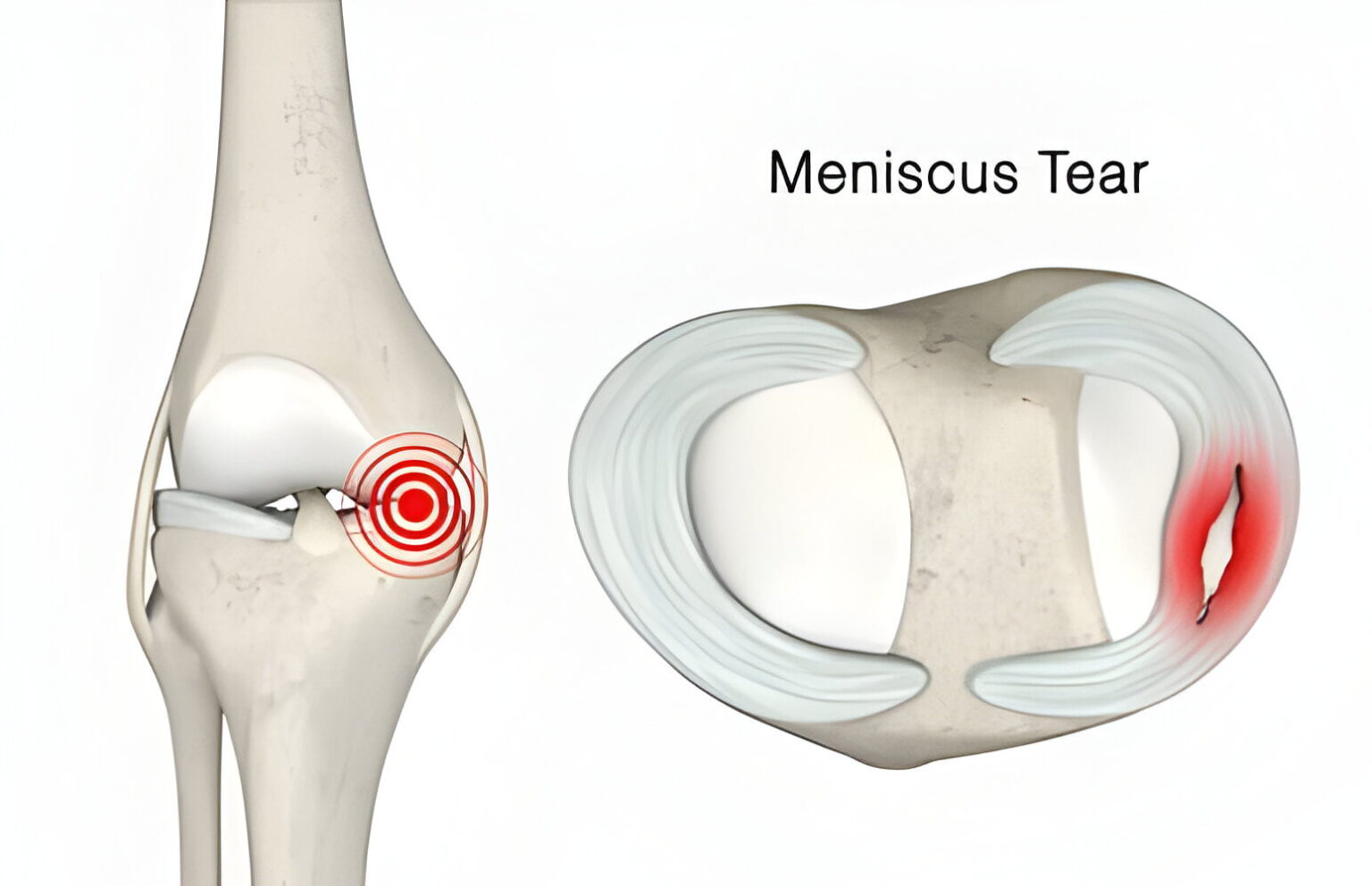 Non-Surgical Recovery for Meniscus Tear: Effective Treatment Options ...